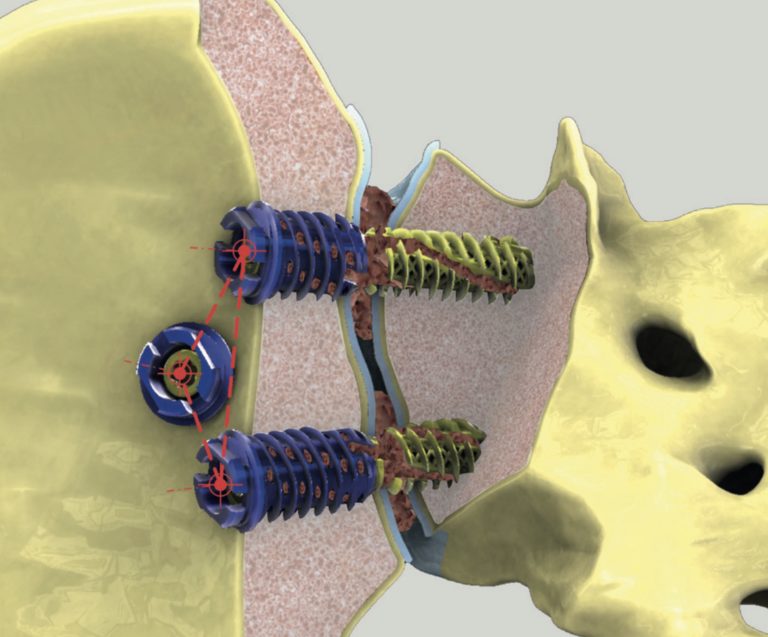 ISG Verschraubung BIld - Praxis für Neurochirurgie und ...